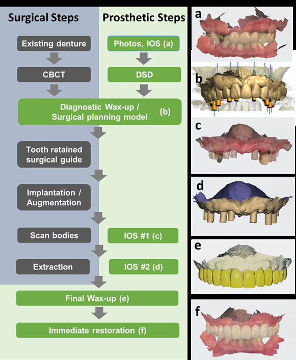 A Versatile Integrated Digital Prosthetic Workflow for the Immediate ...